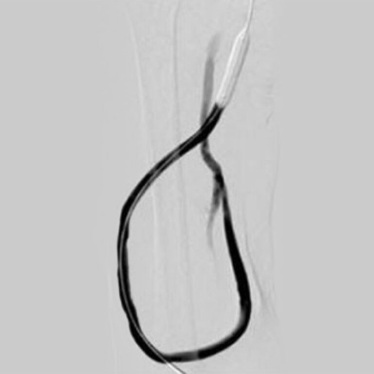 Clinical Information Hub - Mozarc Medical